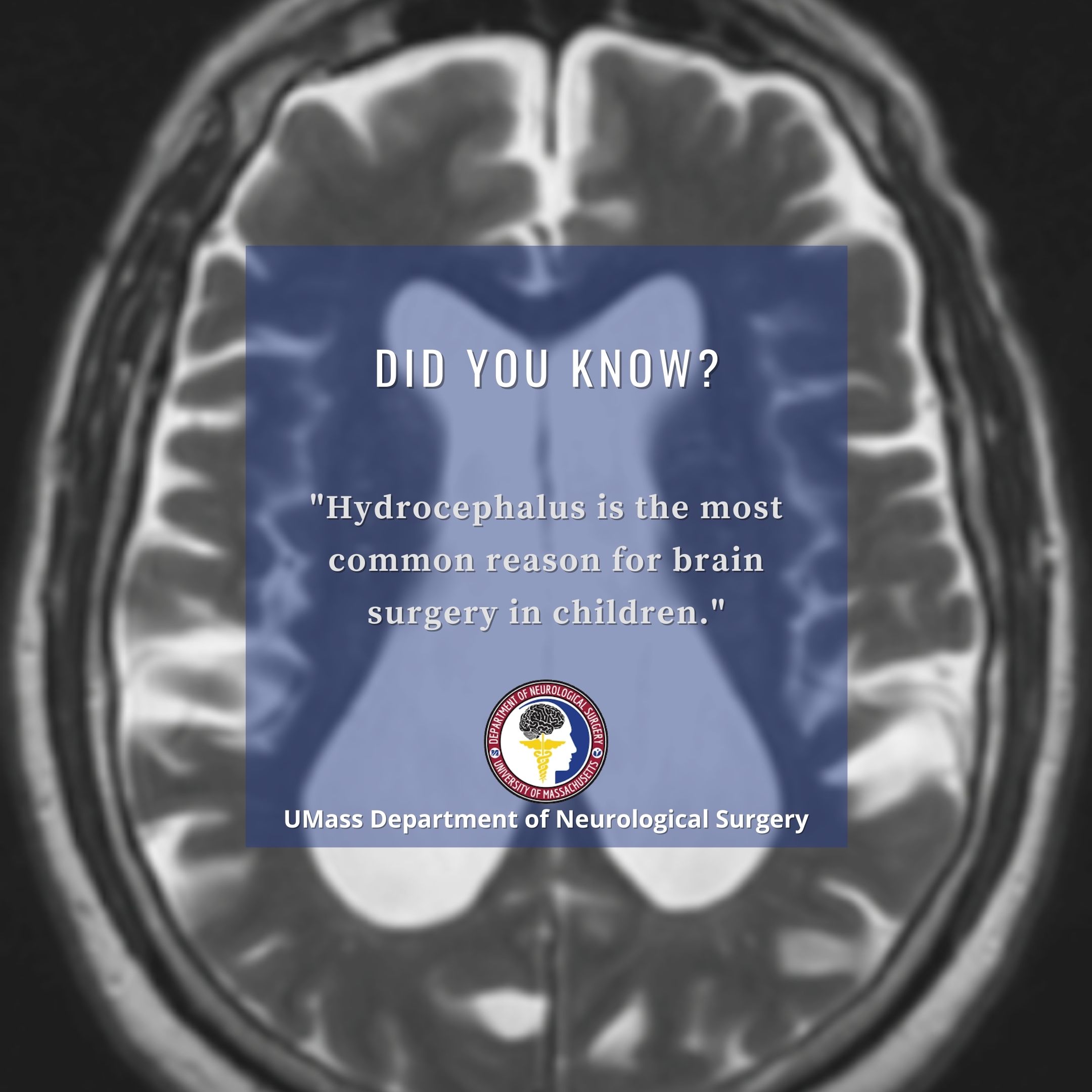 How Common Is Hydrocephalus