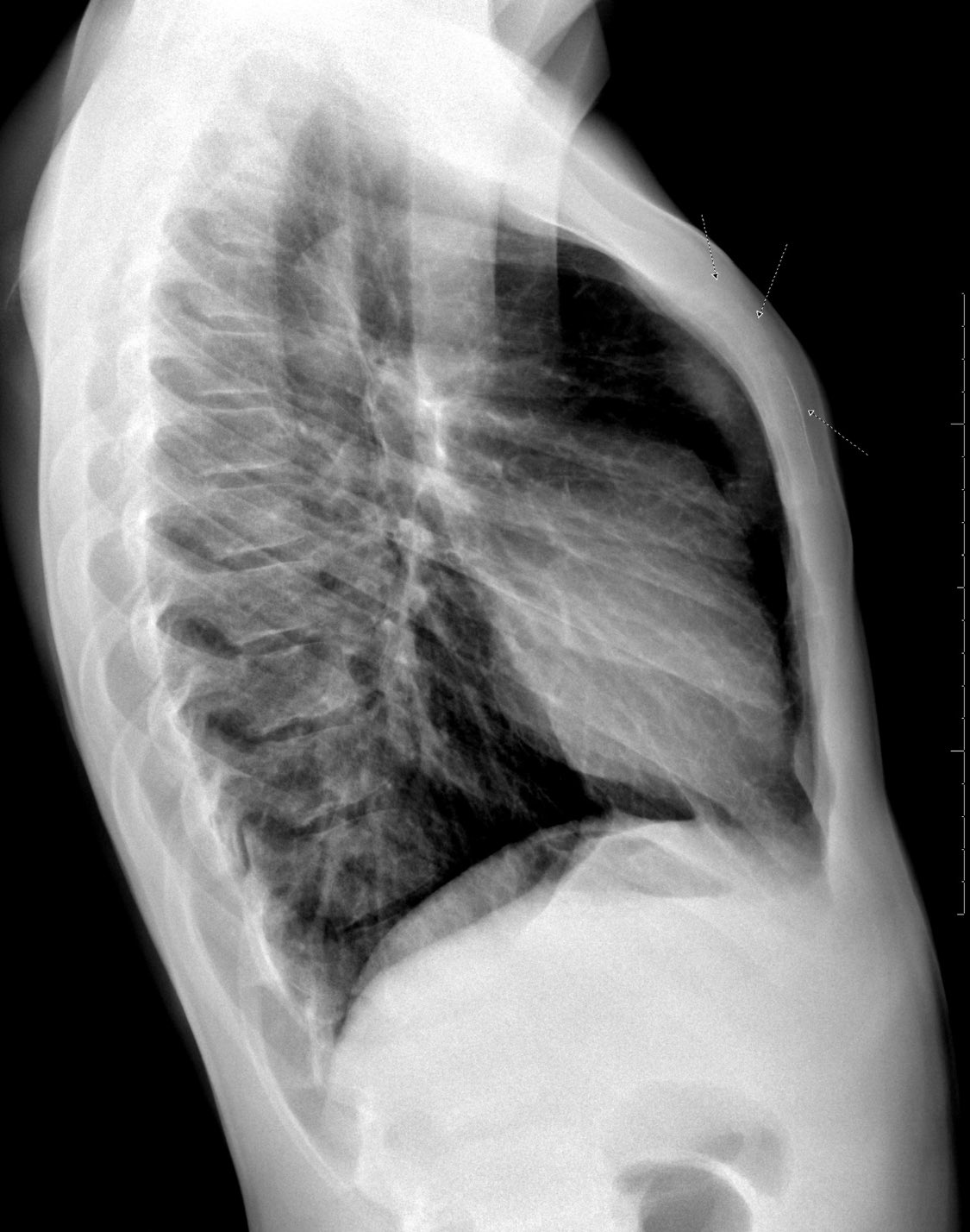 Pectus Carinatum X Ray