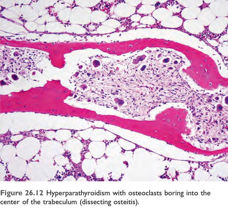 Osteitis Fibrosa Cystica Brown Tumor