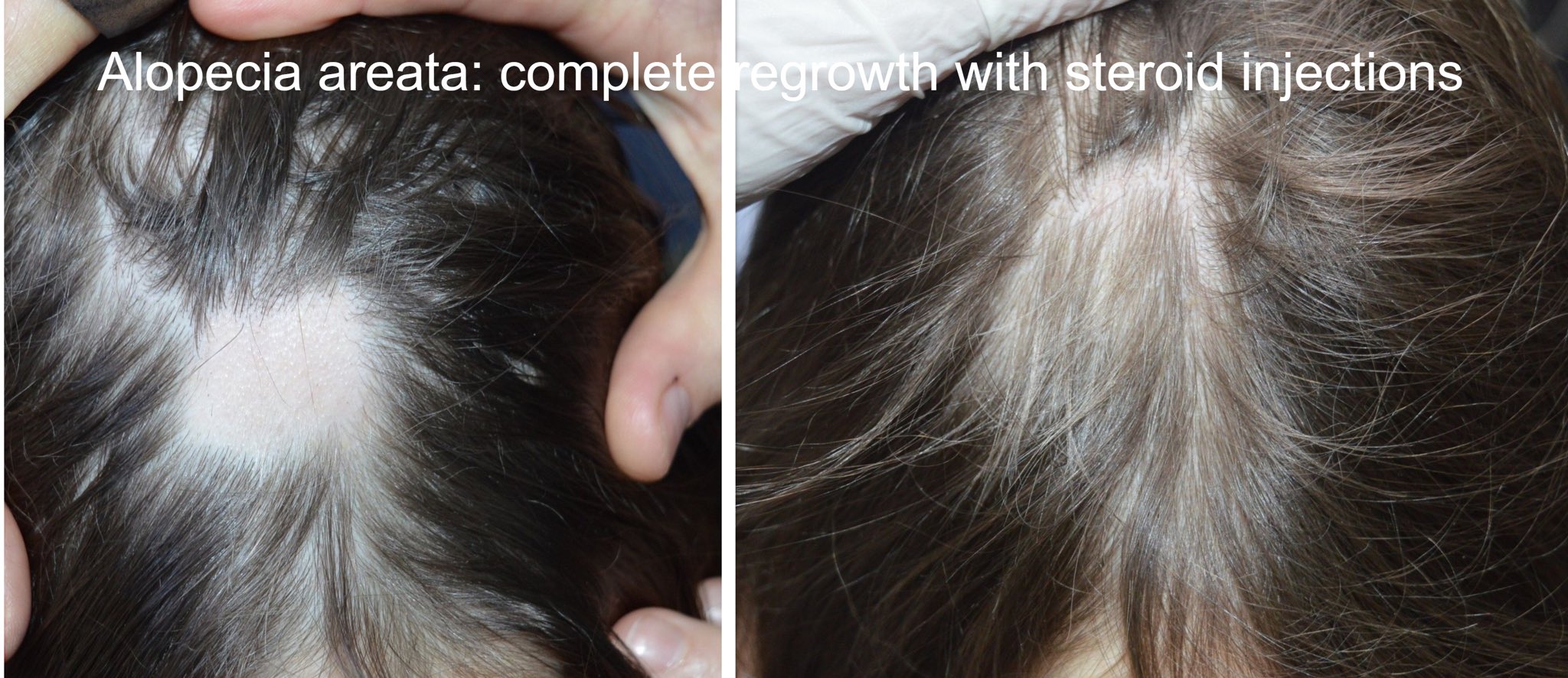 Alopecia Universalis Regrowth