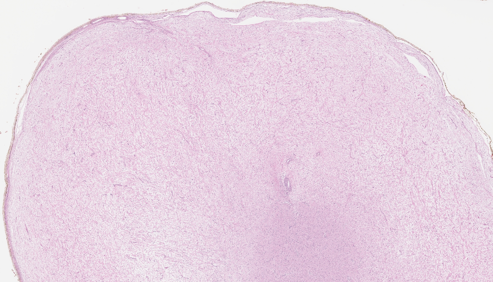 Neurofibroma Histology