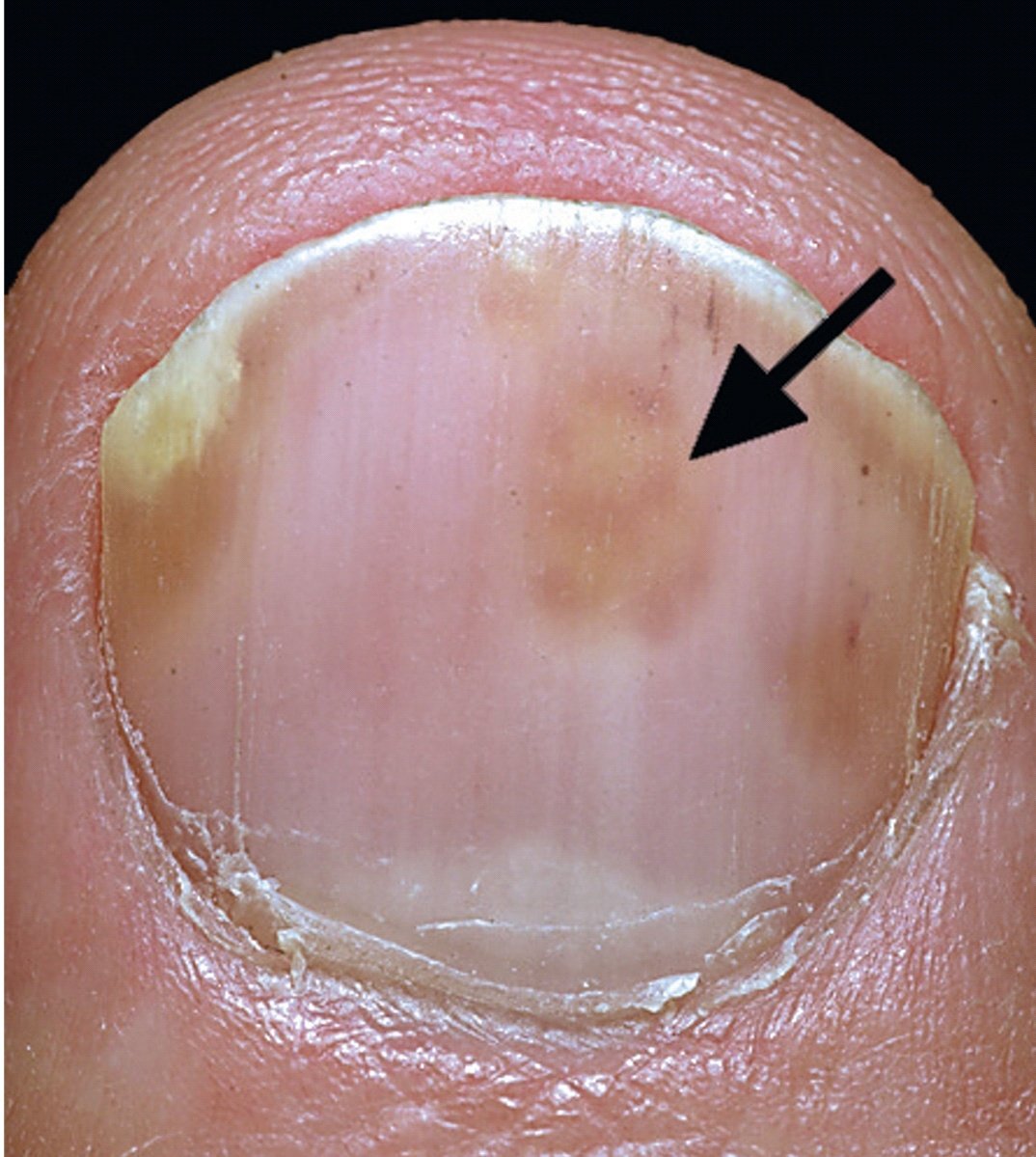 Psoriasis Nails Oil Spot