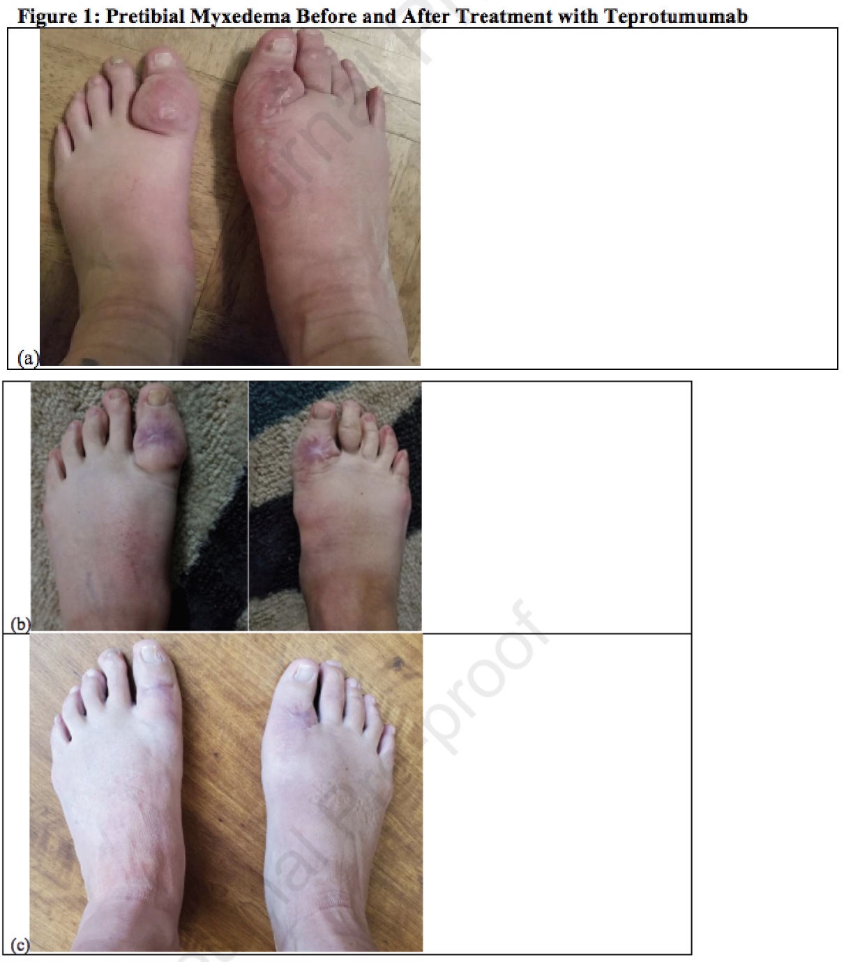 Myxedema Before And After Hormones.gr