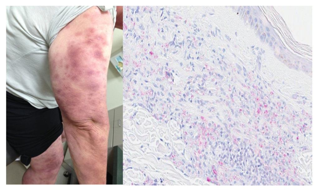 Images of Infectious Diseases 64F. FL. Seronegative RA x 5y. Rx MTX ...