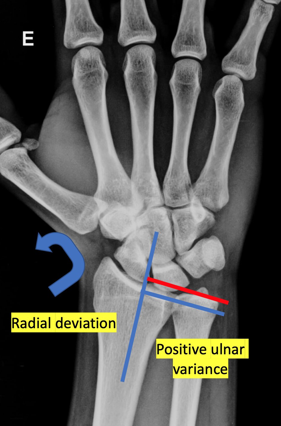 Ulnar Deviation X Ray Radiographic Imaging Of Scaphoid Frx : Wheeless'