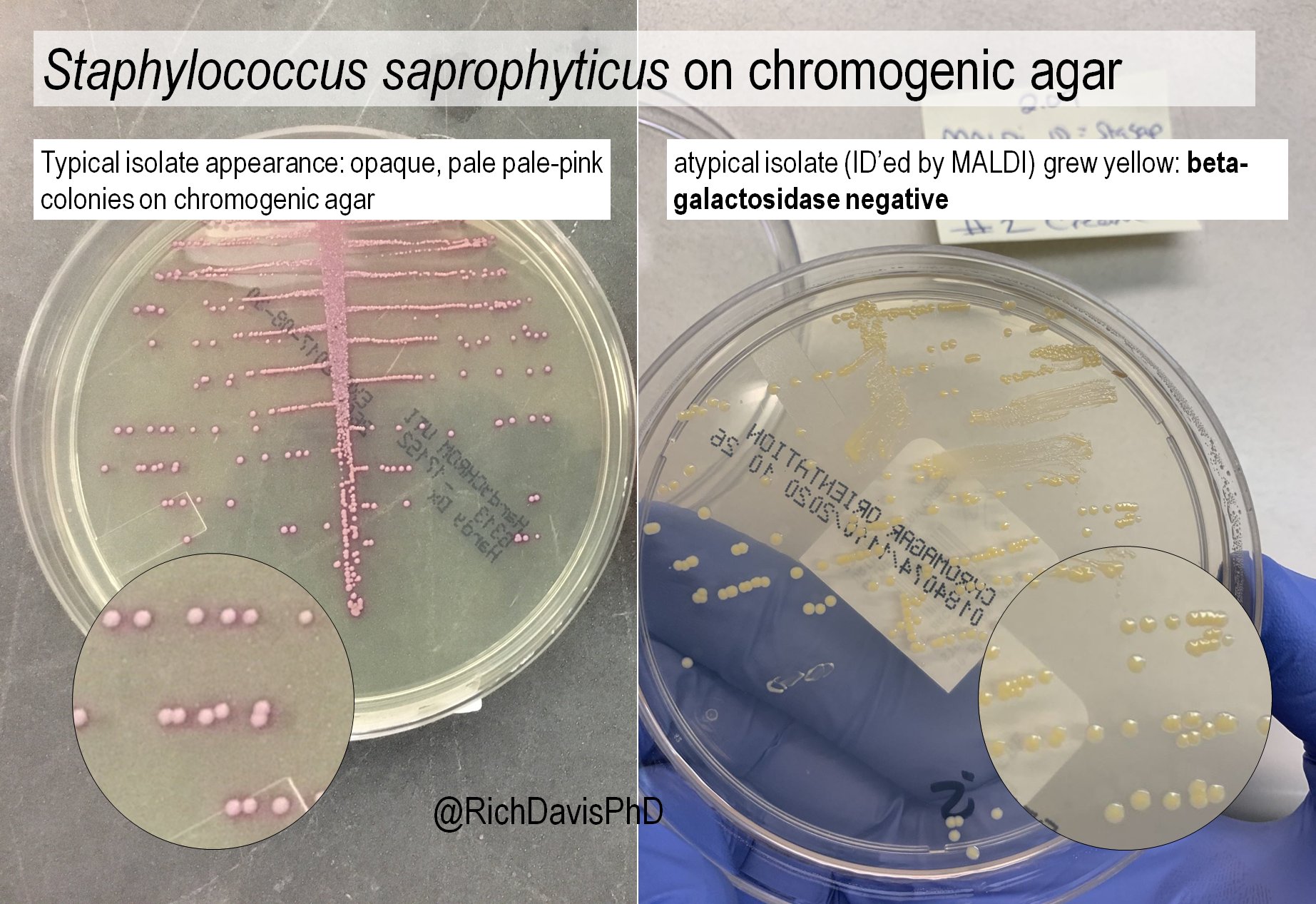 Staphylococcus Saprophyticus