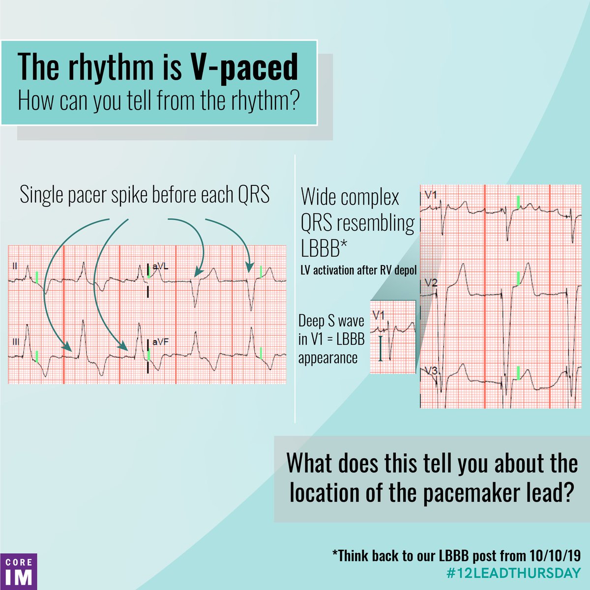 1/ It’s #12LeadThursday, #MedTwitter, and y’all know what that means ...