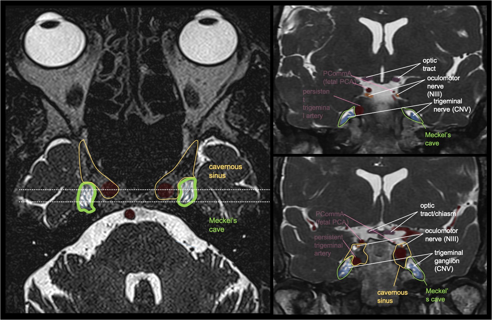 Meckels Cave Mri Anatomy