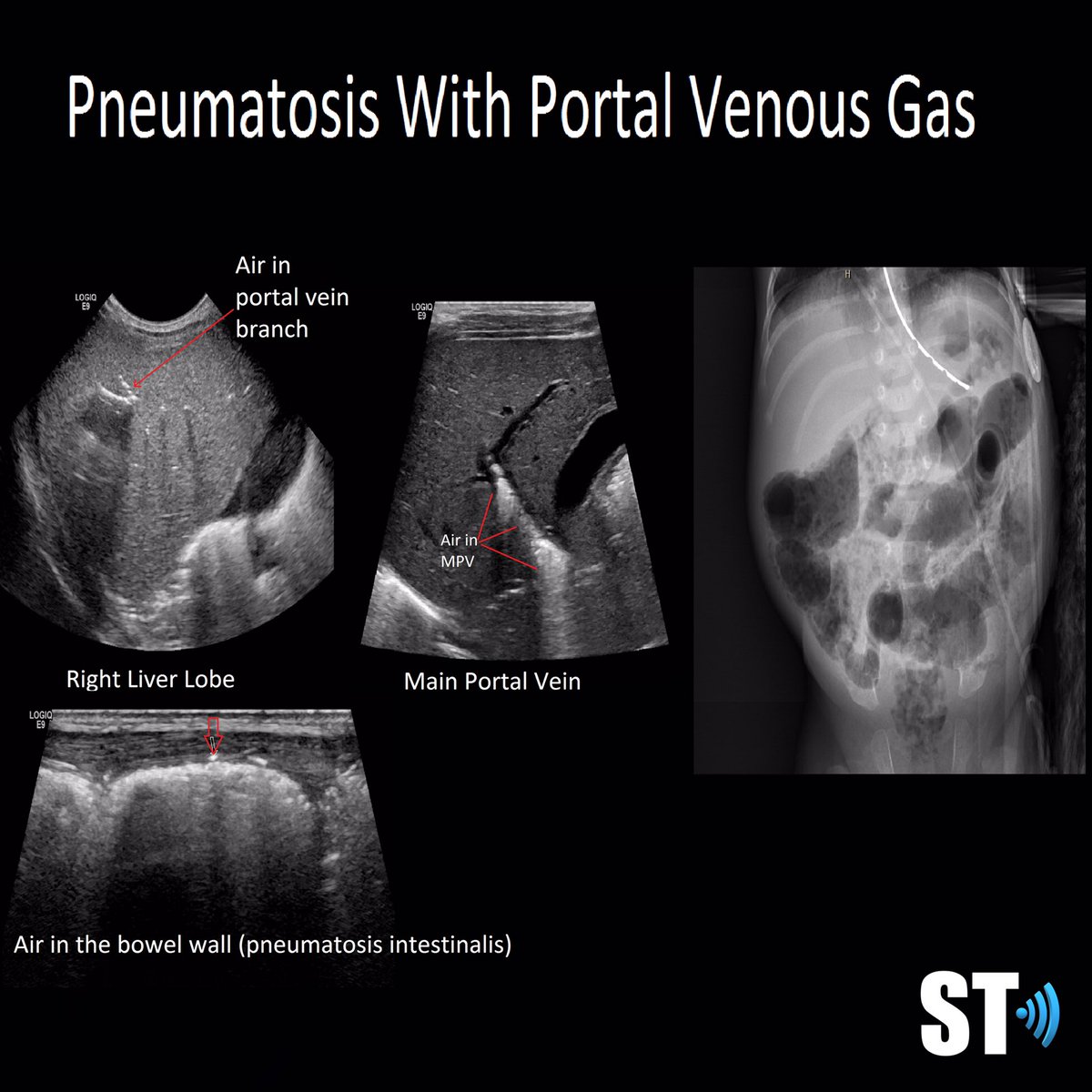 Pneumatosis Intestinalis Necrotizing Enterocolitis