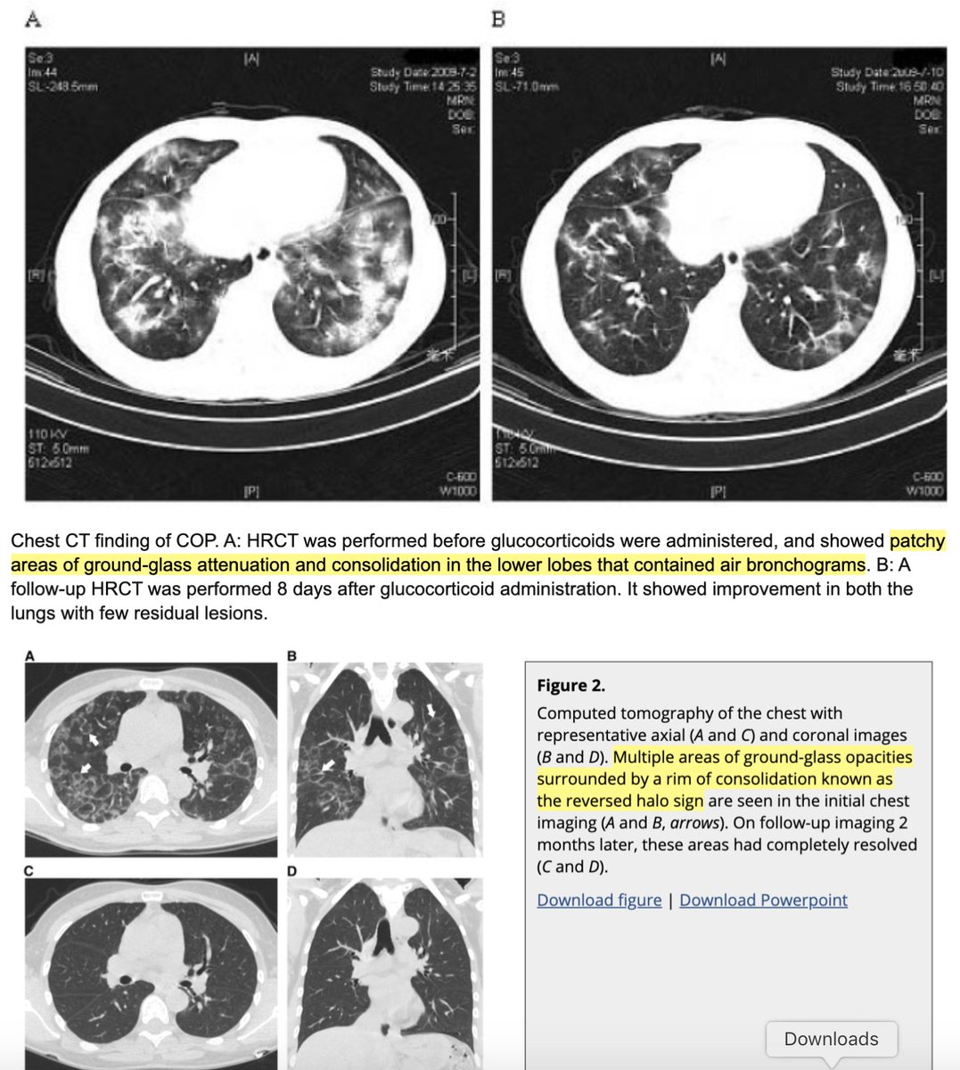 Kicking off this Monday w/ some UpToDate points on 💨CRYPTOGENIC ...