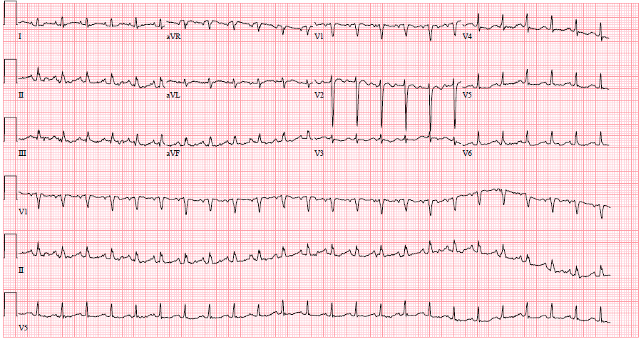 36F presenting with SOB, cough, subjective fever. BP 101/58, HR 140, T ...