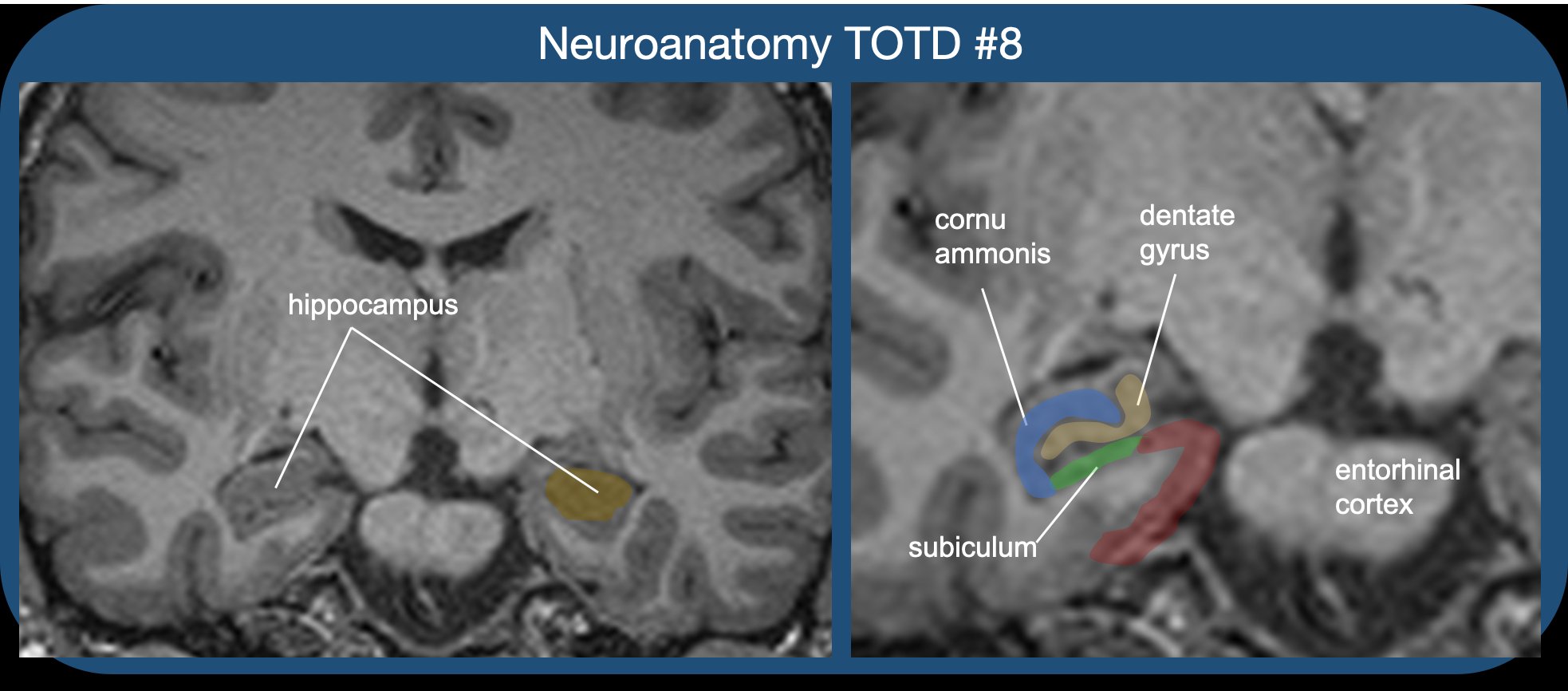 Dentate Gyrus Mri