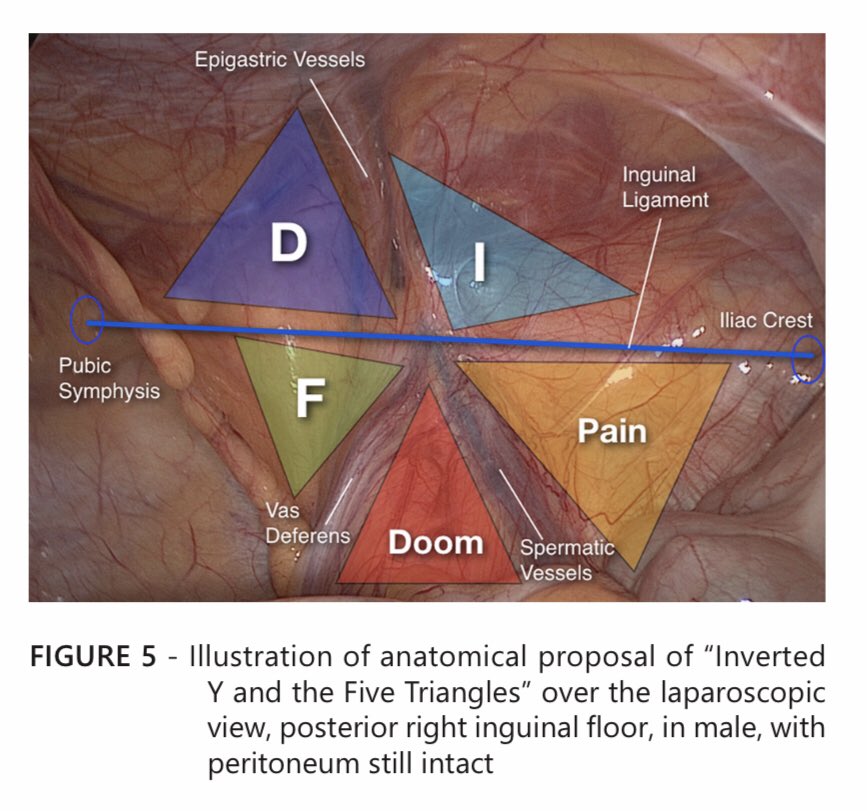 Laparoscopic Inguinal Hernia Repair Triangle Of Doom