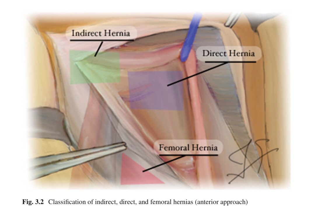 Direct Vs Indirect Hernia