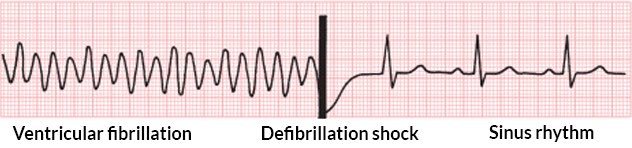 #التمريض. Synchronized Cardioversion VS Defibrillation - Thread from ...