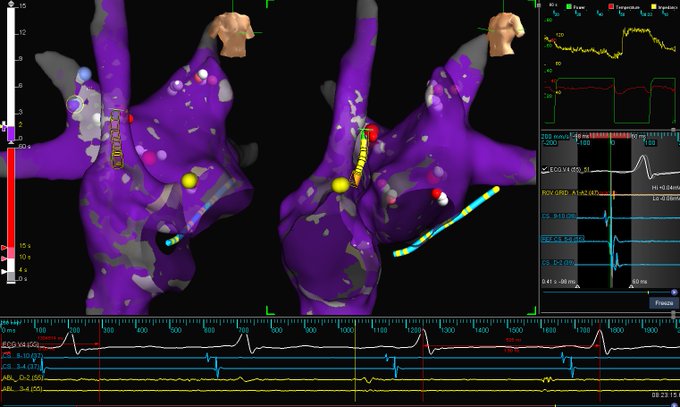 What is an Electrophysiology Laboratory or EP Lab? Where is an AFib ablation performed?