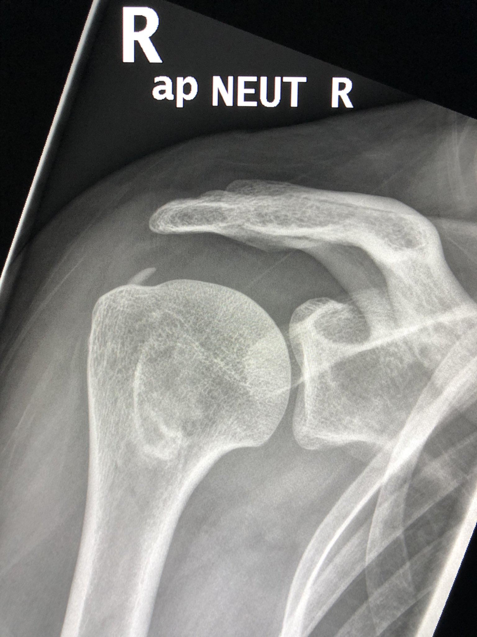 External Rotation Shoulder Xray