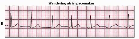 Wandering Atrial Pacemaker