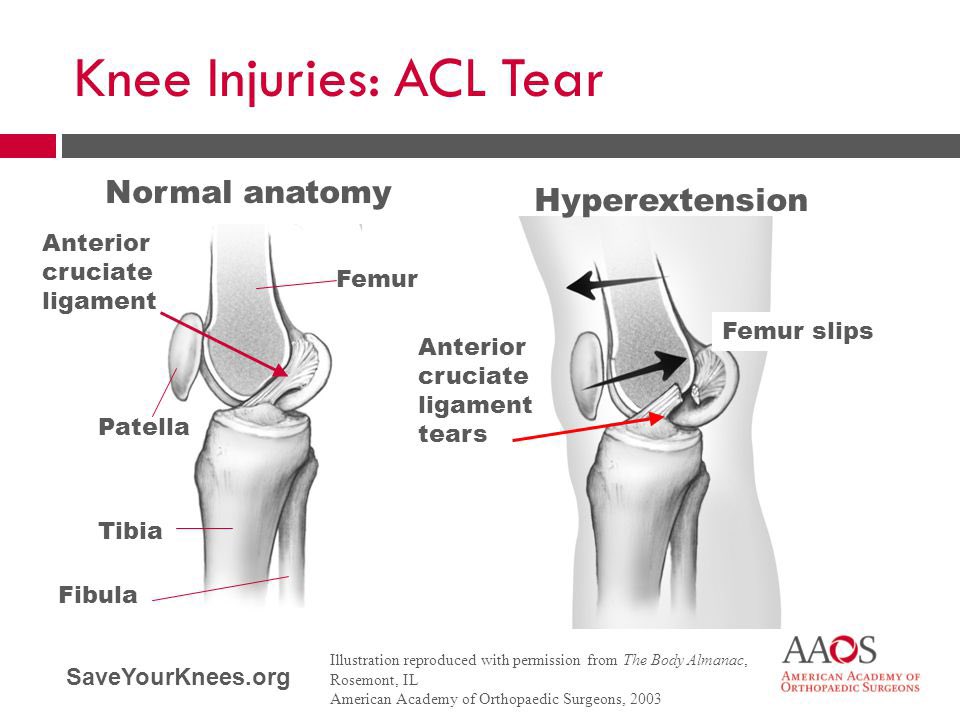 Hyperextended Knee: Symptoms, Causes Treatment, 45% OFF