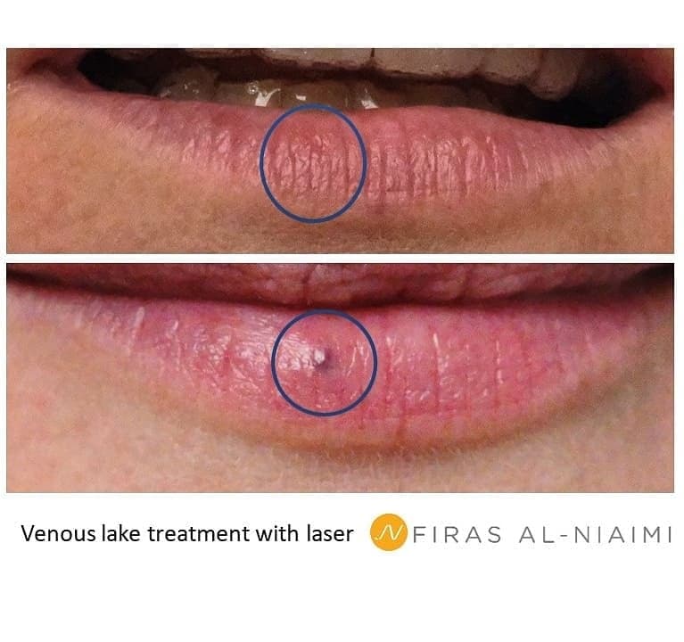 Cherry Angioma On Lip