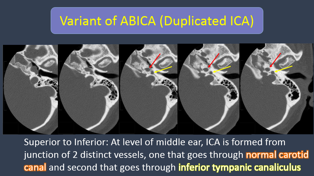 Inferior Tympanic Canaliculus