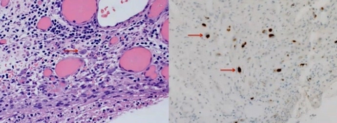 Images of Infectious Diseases This is histopathology (H&E and ...