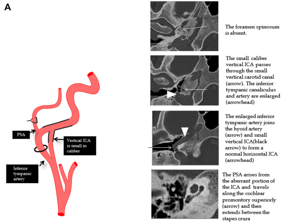 Inferior Tympanic Canaliculus