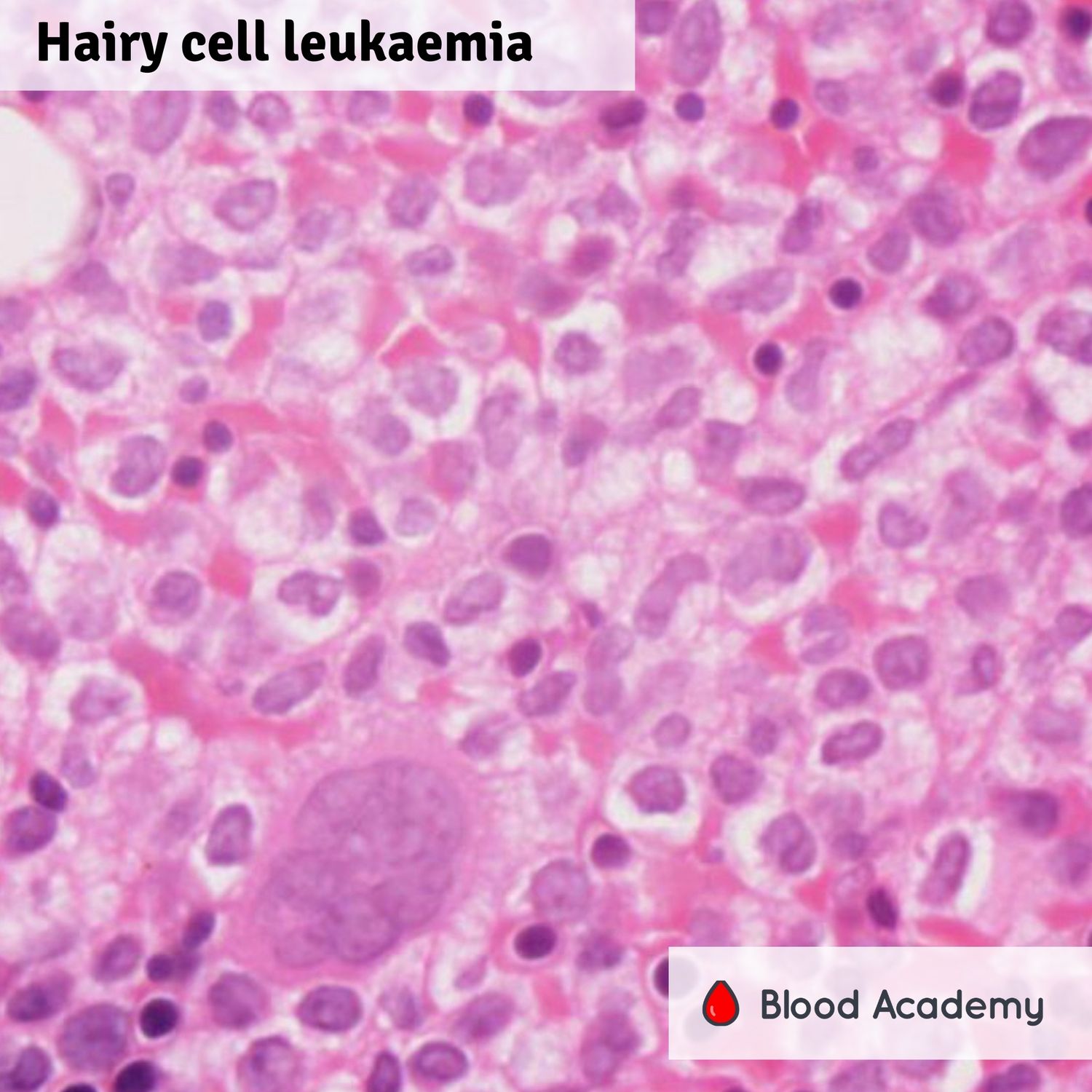 Blood Academy on Twitter: "1/ Hairy cell leukaemia Bone marrow aspiration in #hairycellleukaemia ...