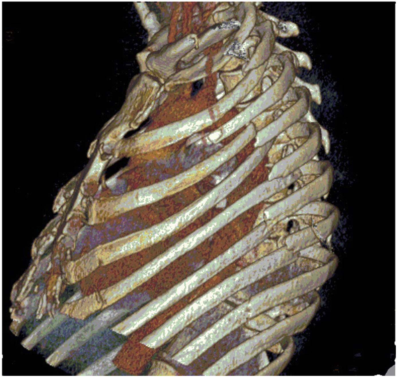 What Is Dogs Flail Chest