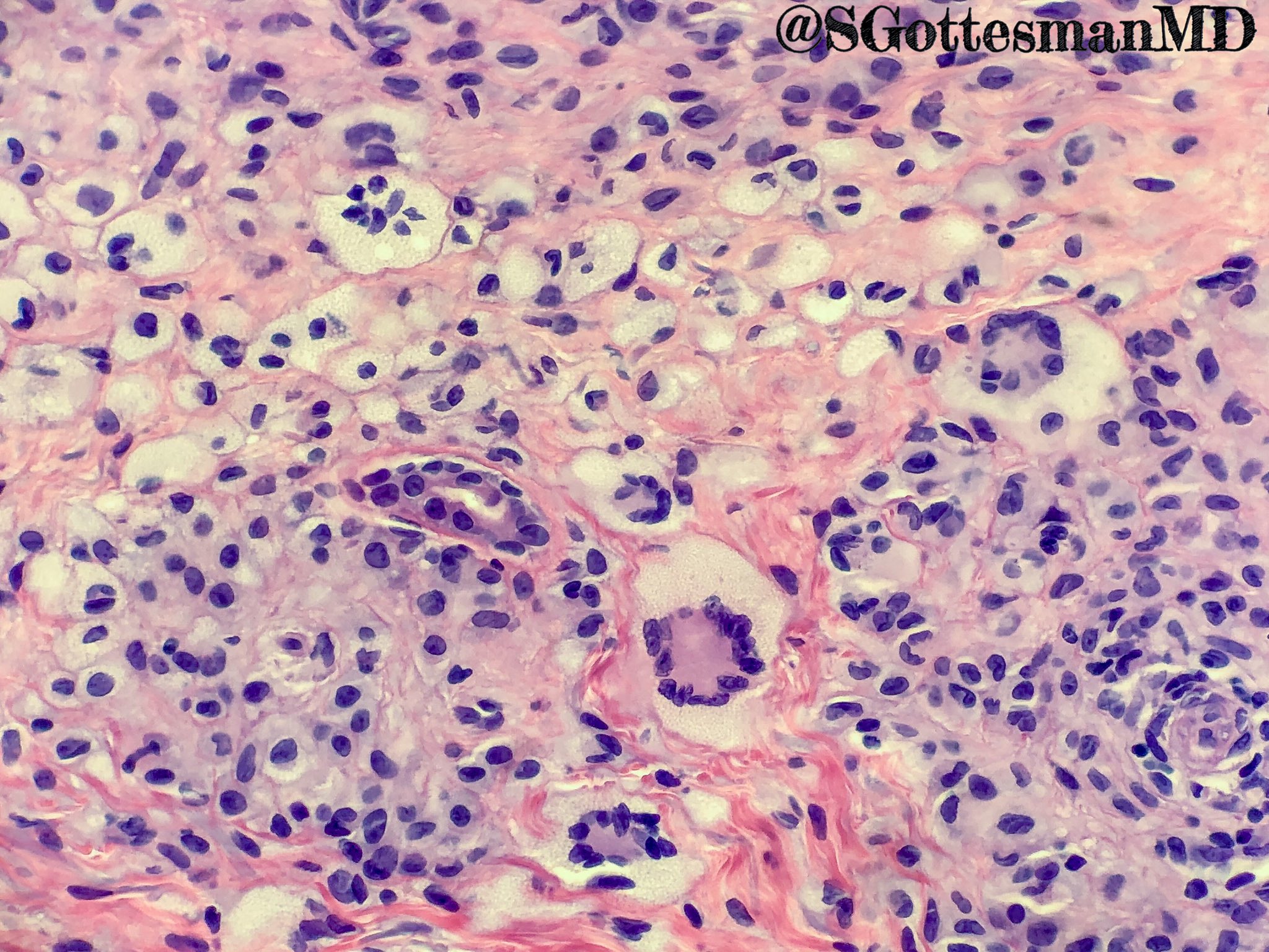 Necrobiotic Xanthogranuloma Histology