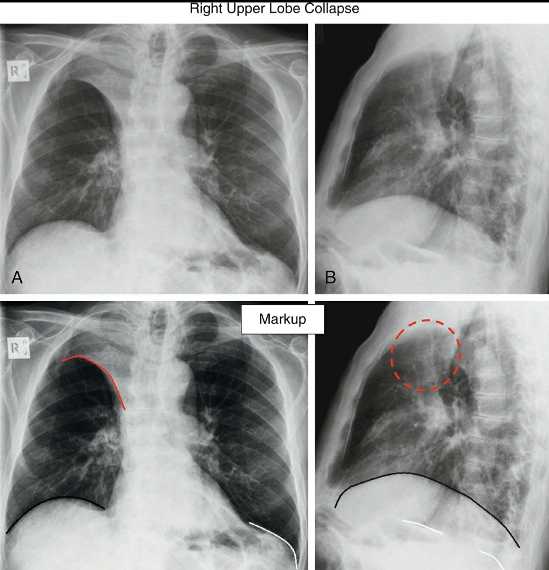 Right Middle Lobe Collapse X Ray