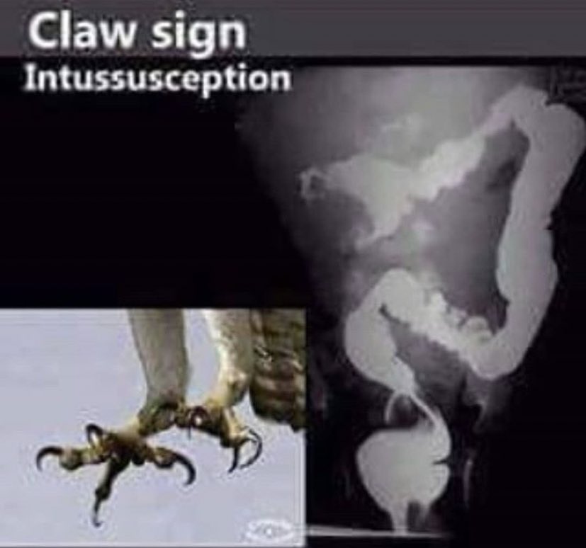 Intussusception Claw Sign Gastrointestinal Imaging | Radiology Key