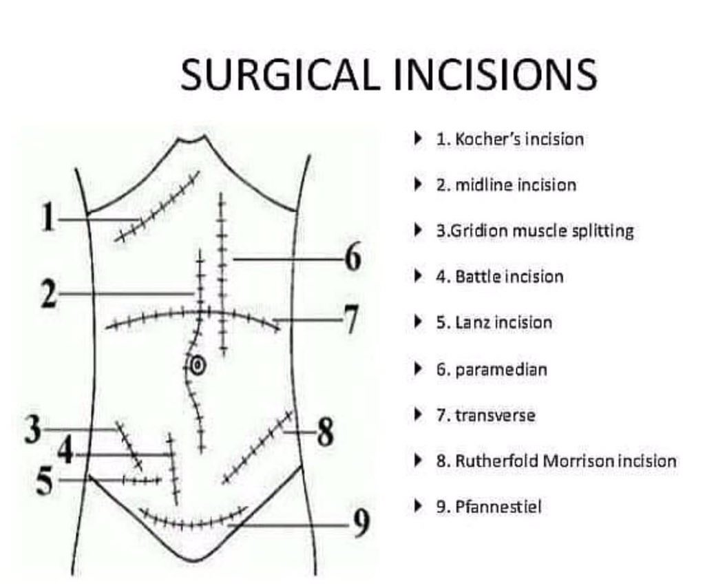 Abdominal Surgical Incisions