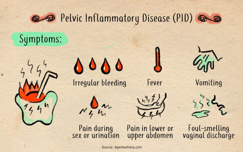 Pelvic Inflammatory Disease Discharge