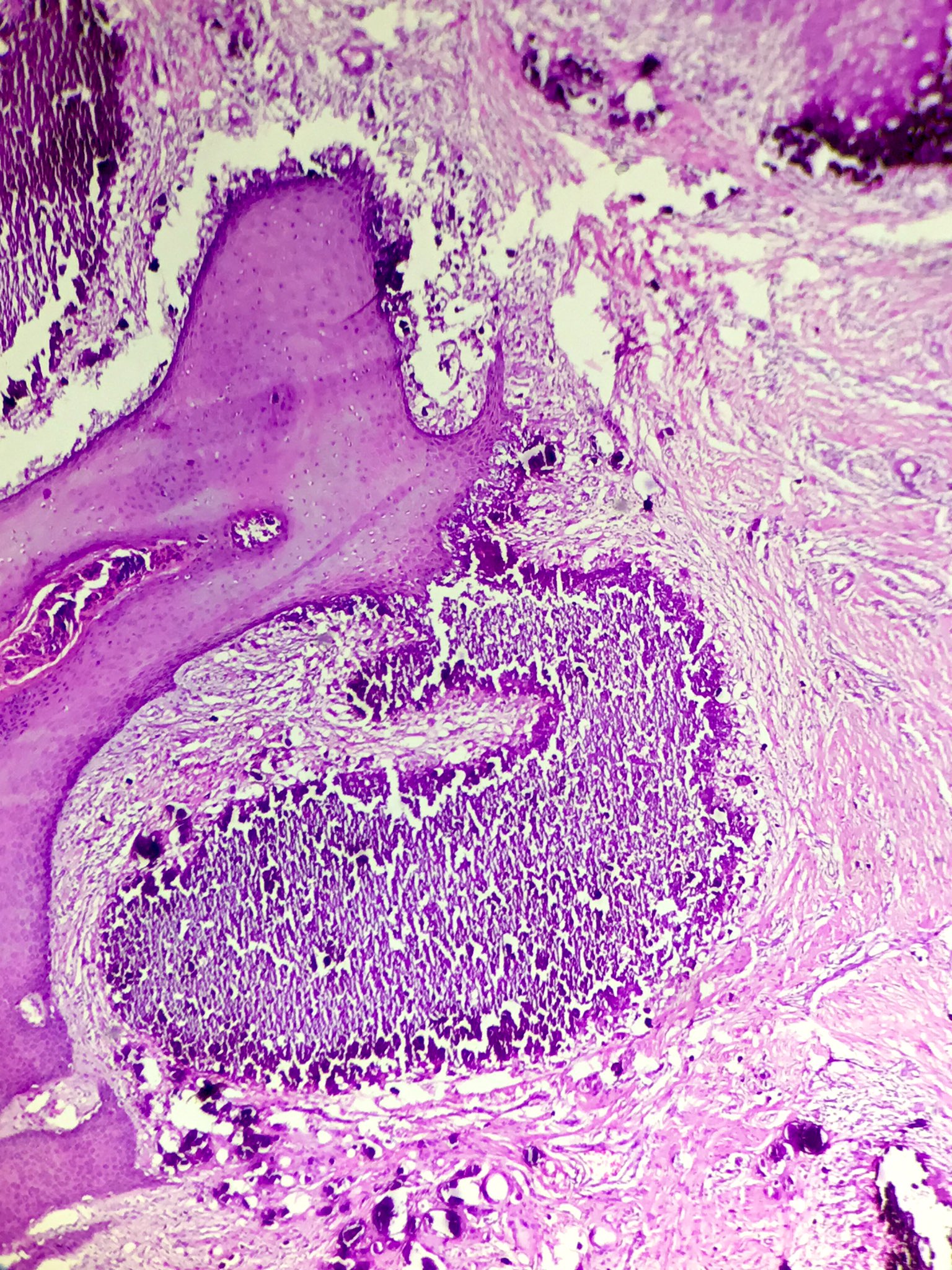 Calcinosis Cutis Histopathology