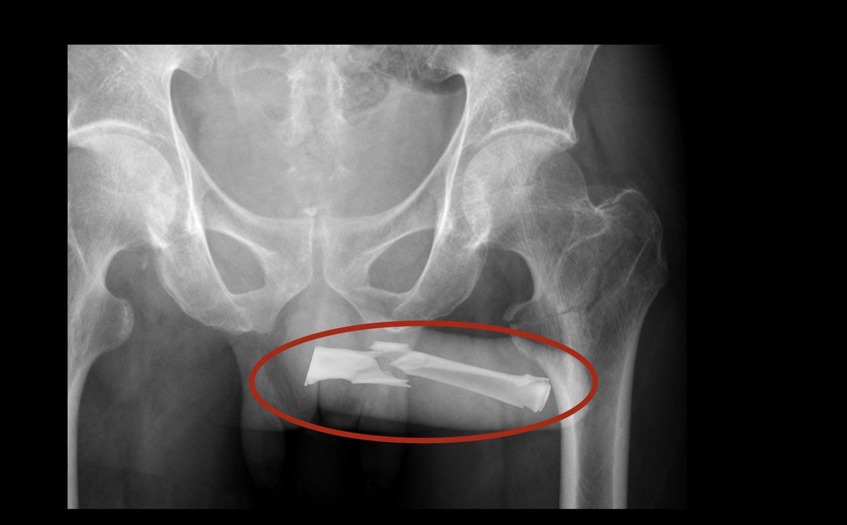 Penile Fracture X Ray