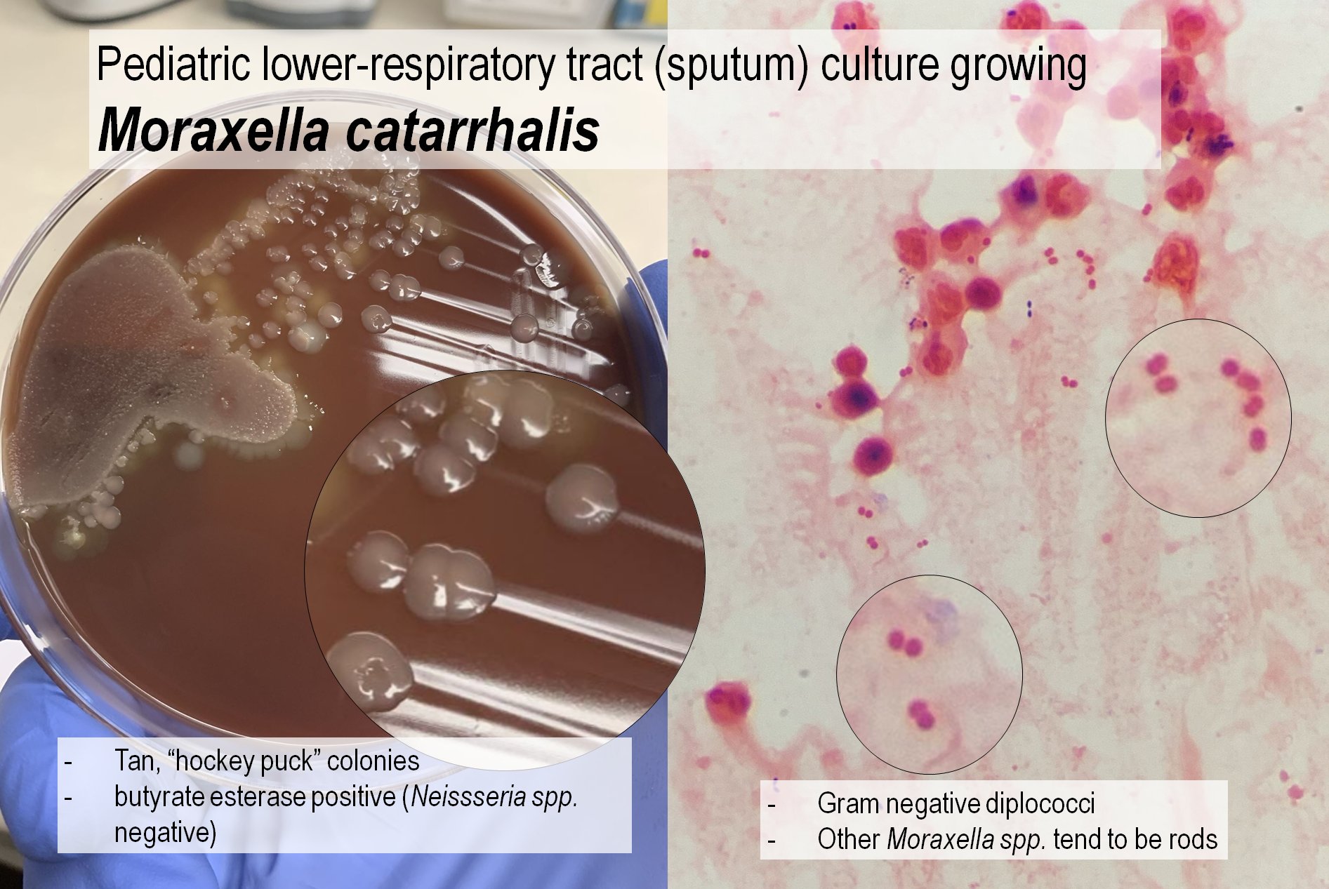 Moraxella Catarrhalis Gram Stain