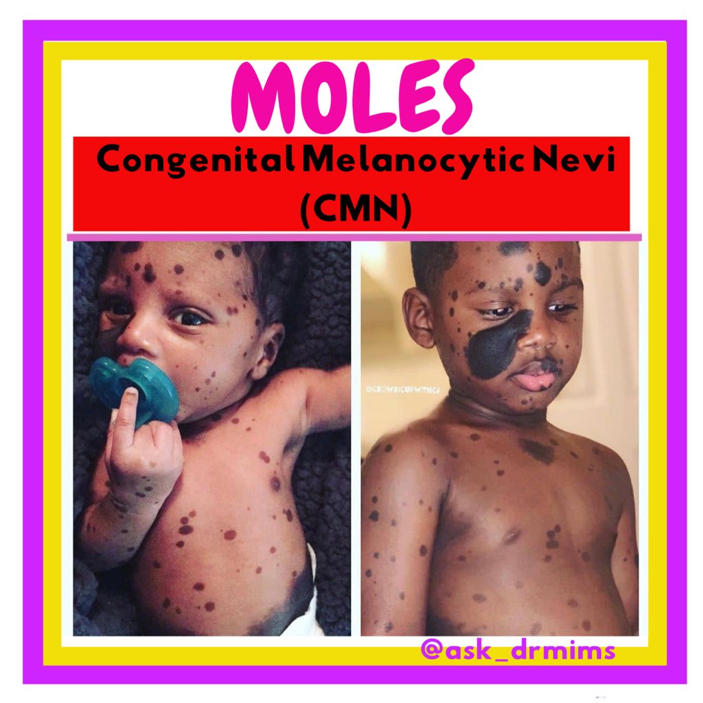 Congenital Moles
