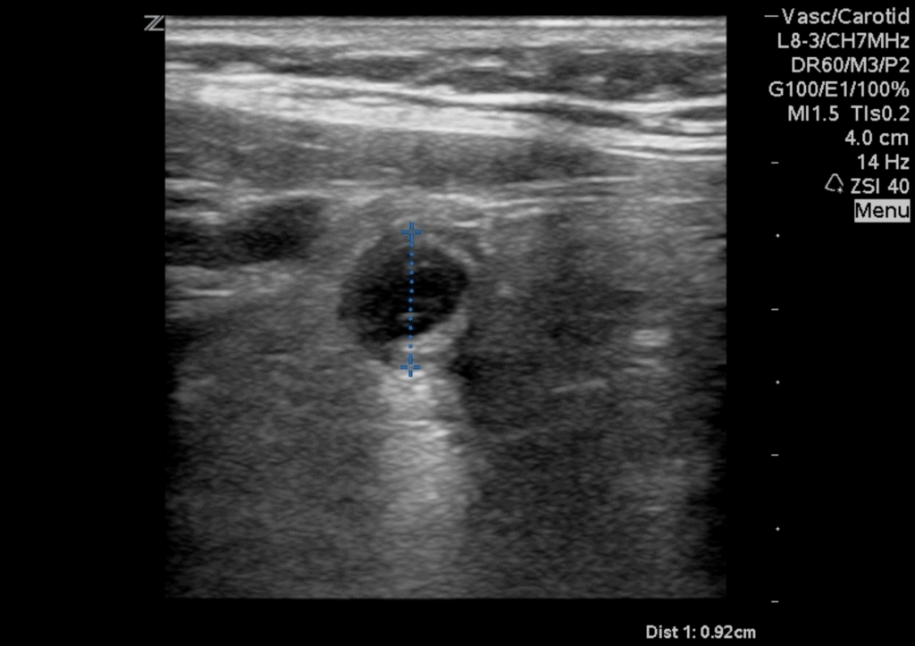 Perforated Appendix Ultrasound
