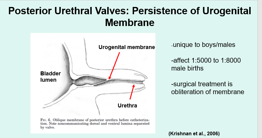 Posterior Urethral Valves Diagram