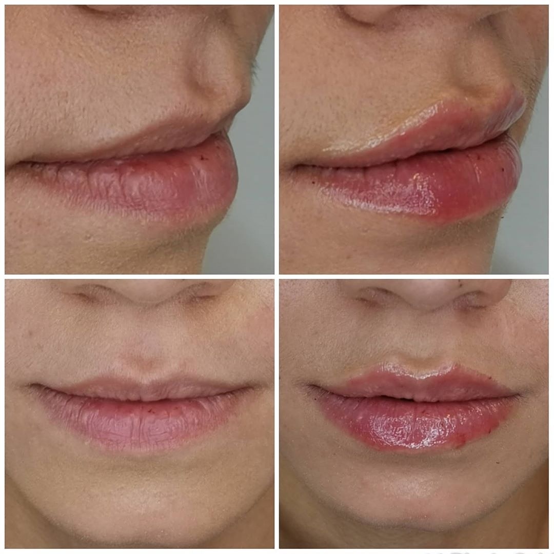Belotero Before And After Lips