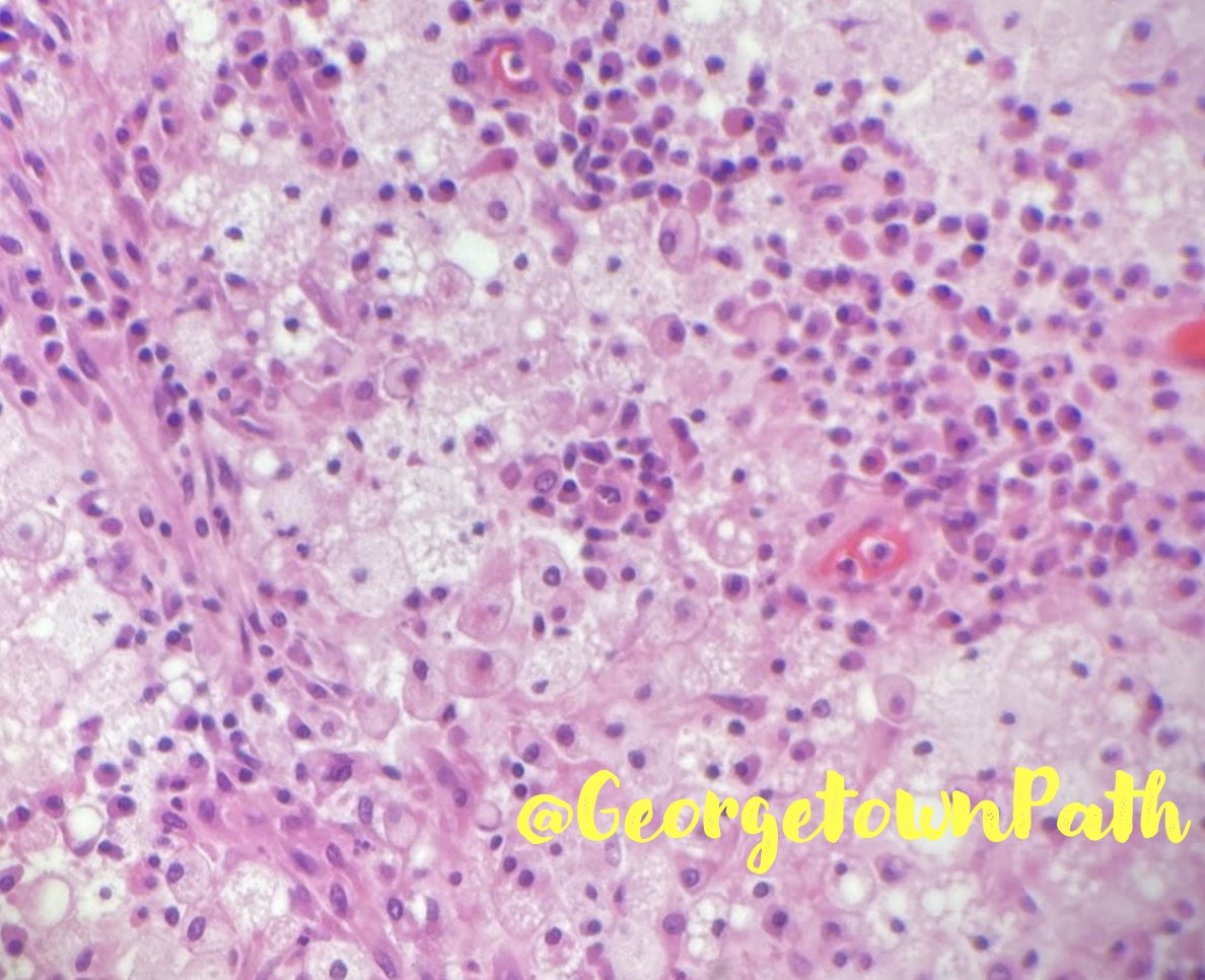 Xanthogranulomatous Pyelonephritis Histology