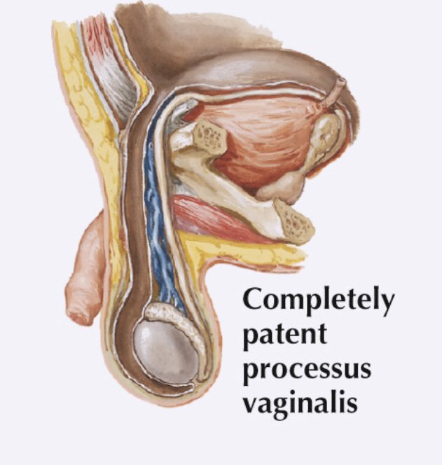 Processus Vaginalis