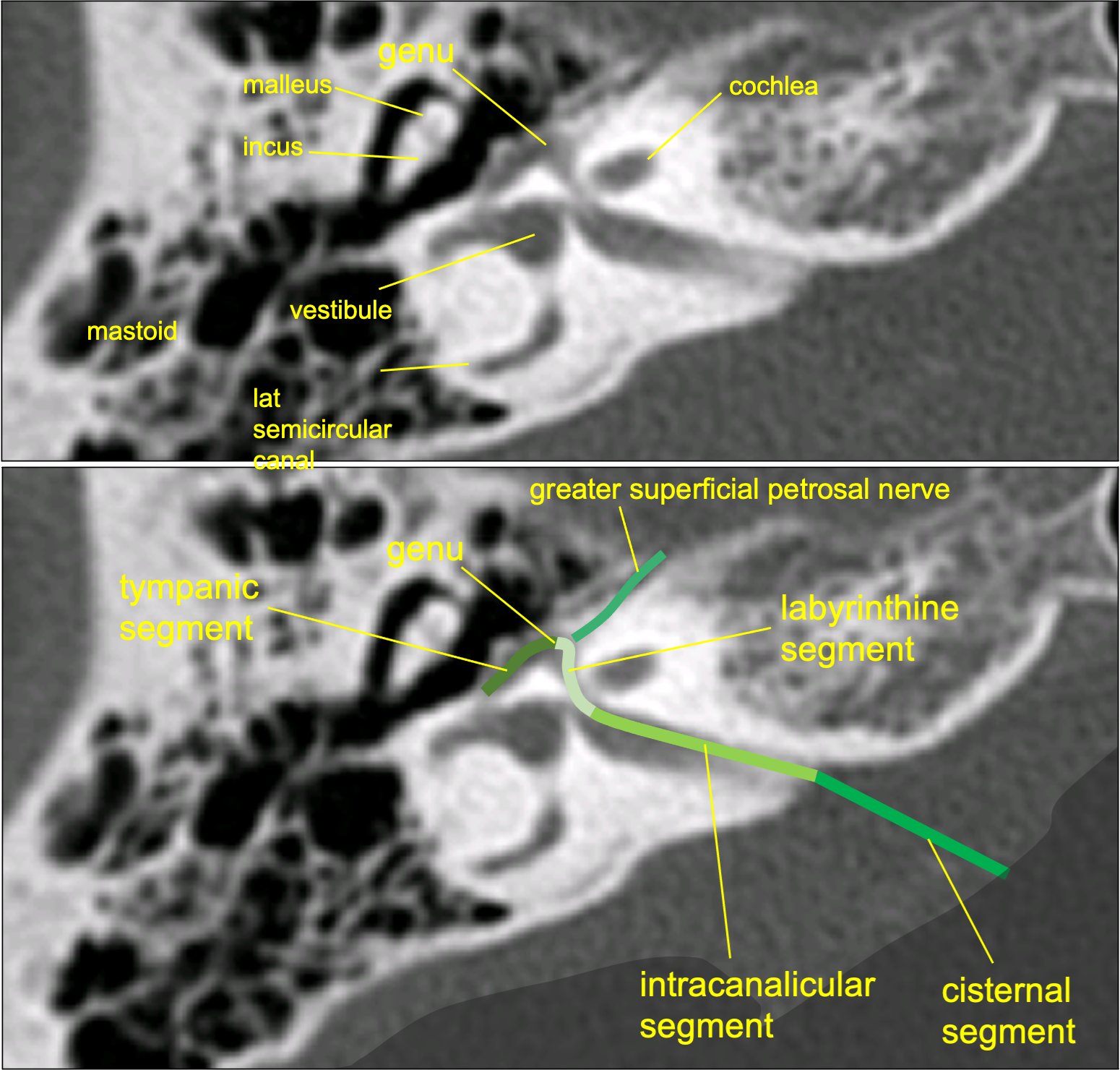 Greater Petrosal Nerve Greater Petrosal Nerve E Anatomy IMAIOS