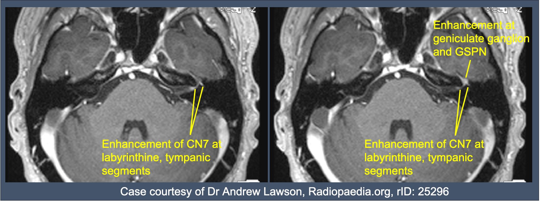 Geniculate Ganglion Mri