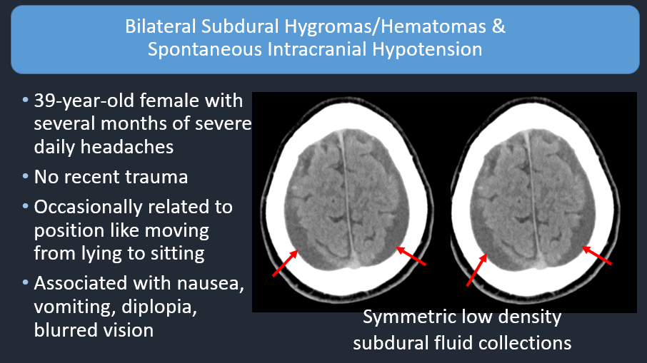 Acute Vs Chronic Subdural Hematoma
