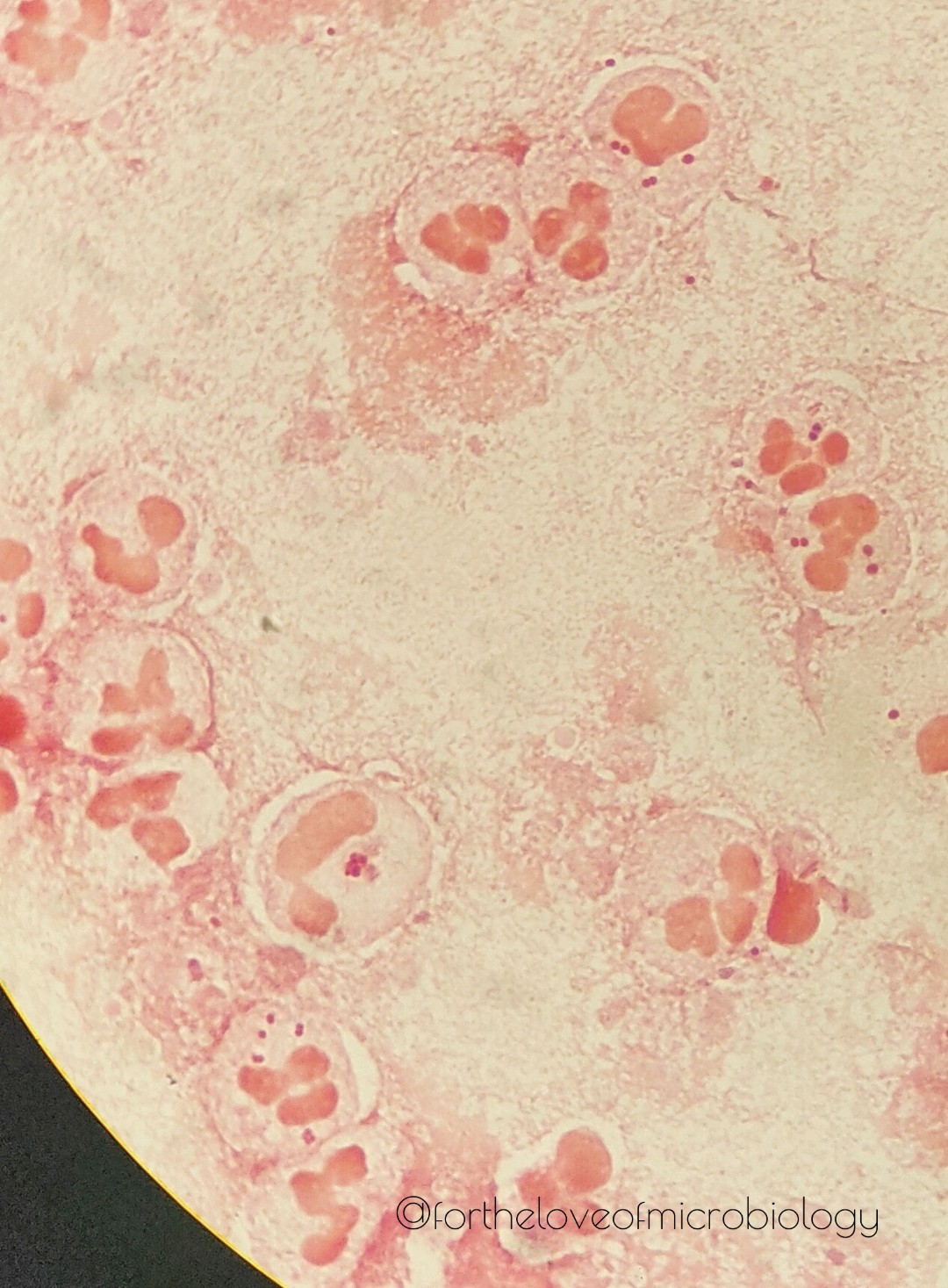 Gram Negative Diplococci In Sputum