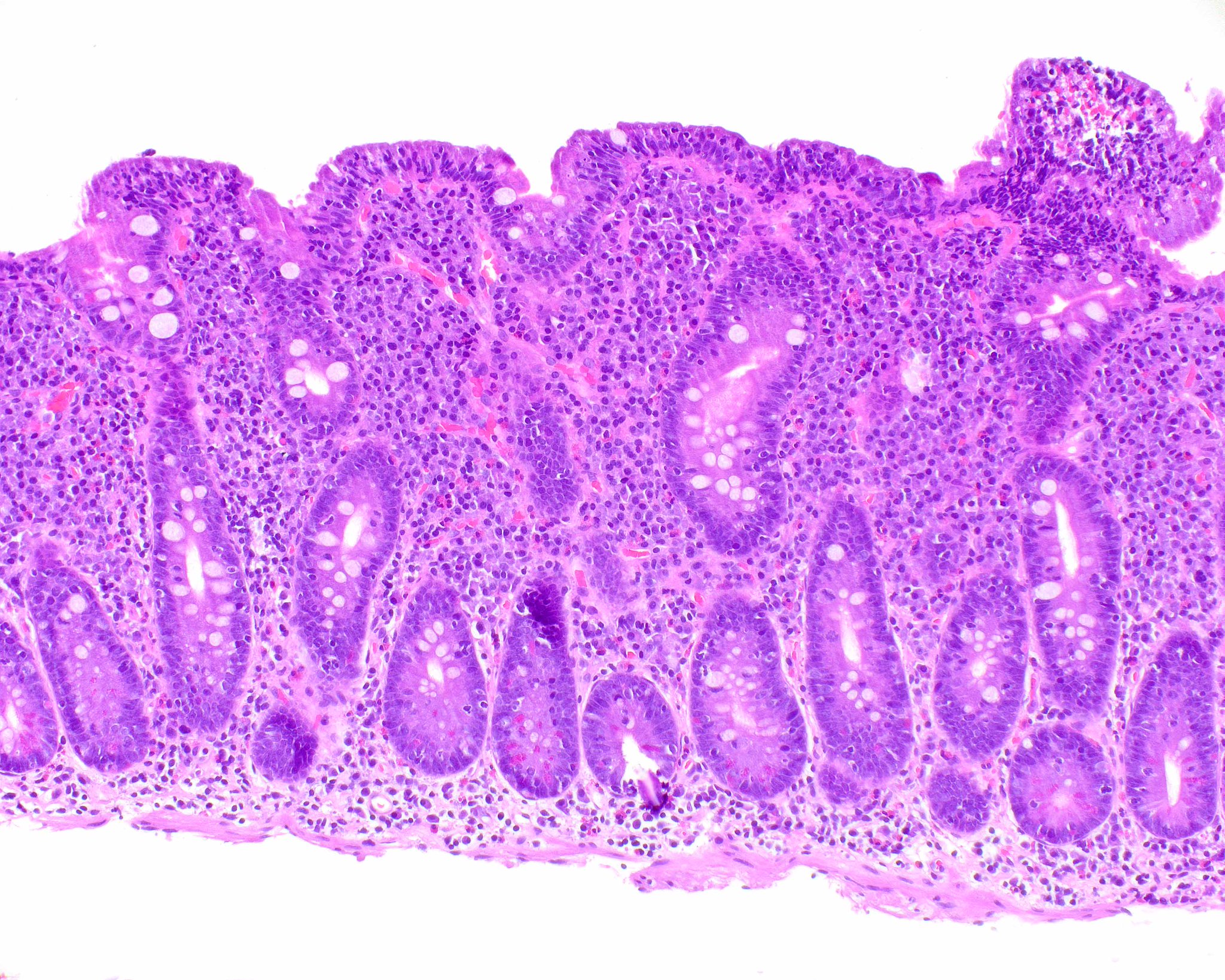 Celiac Disease Histology