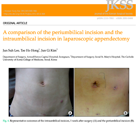 Laparoscopic Appendectomy Incision Sites