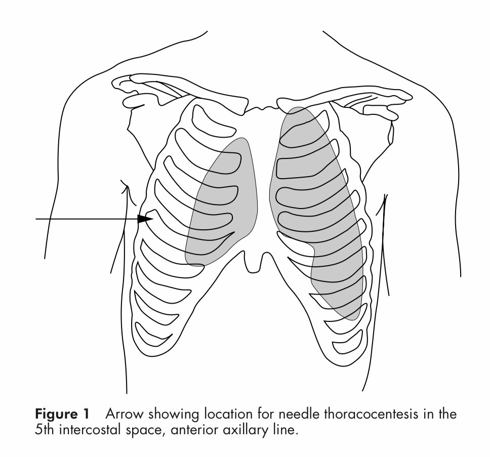 Anterior Axillary Line
